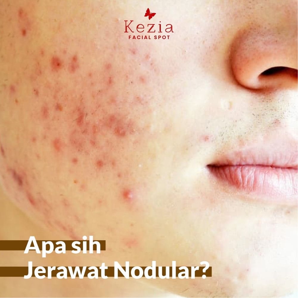 Jenis-Jenis Komedo di Wajah